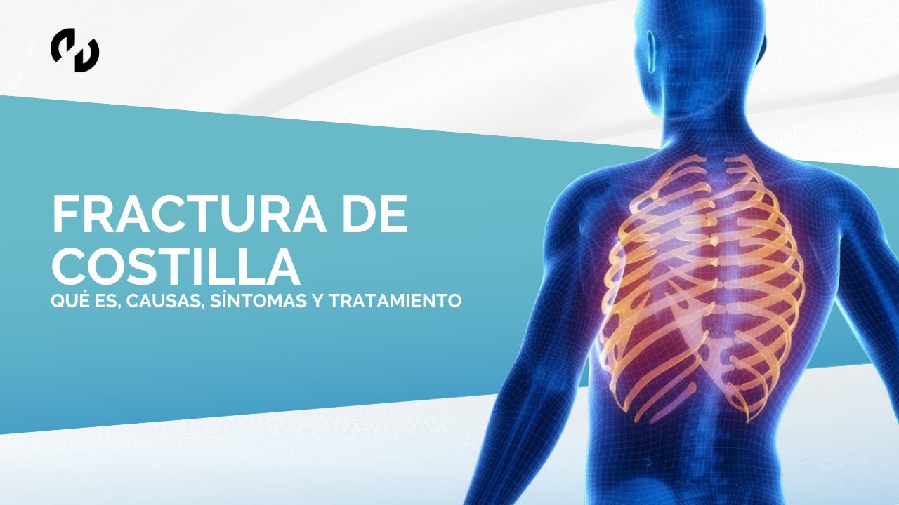 Fractura De Costilla Que Es Causas Síntomas Y Tratamiento Youtube