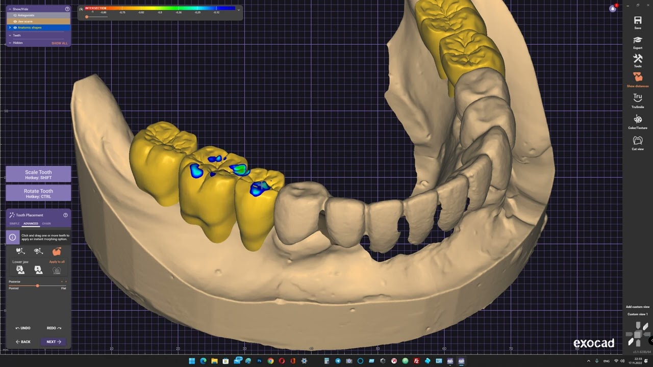 Exocad Crack Partial Framework Softdental