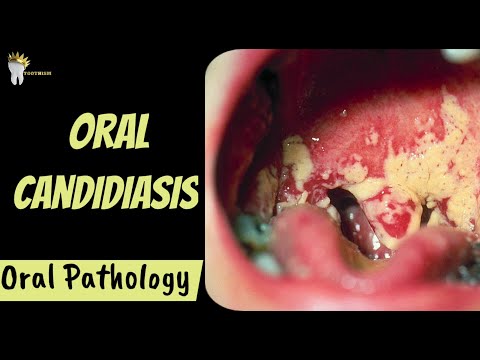 Oral Candidiasis (Oral Thrush) | Causes, Pathophysiology, Signs ...