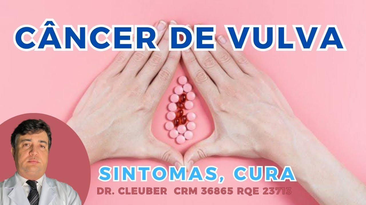 Câncer De Vulva Prevenção Diagnóstico E Tratamento Cirúrgico Youtube