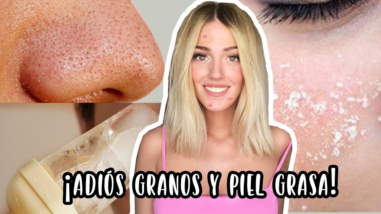 Cómo Eliminar Un Grano En Un Día 5 Tips Para Eliminar Grasa Acné