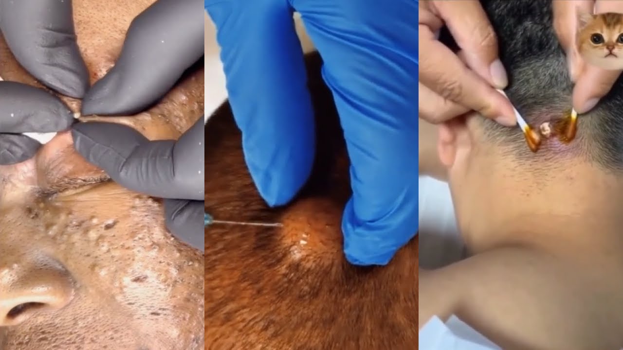 17 Minutes Popping Pimples Removal Blackheads And Cyst Best Pimple