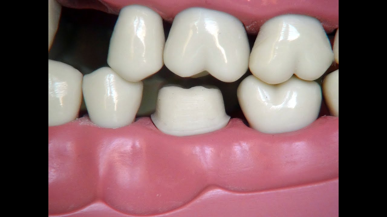 What Is Dental Crown Prep At James Saavedra Blog