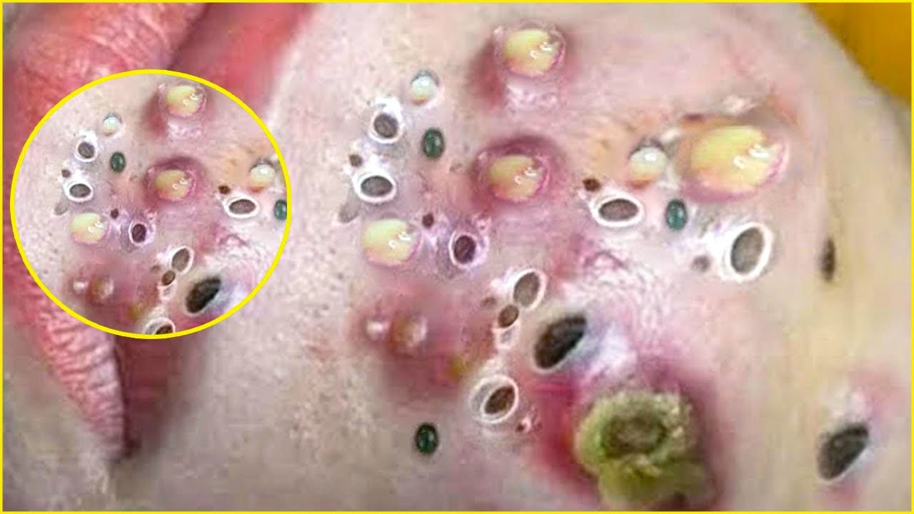 Botfly Maggot Removal Inflammatory Acne Relax Every Day With Satisfying