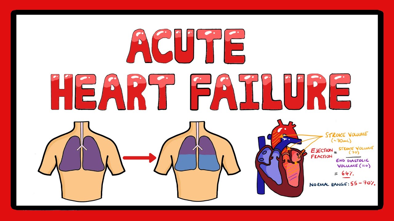 Acute Heart Failure