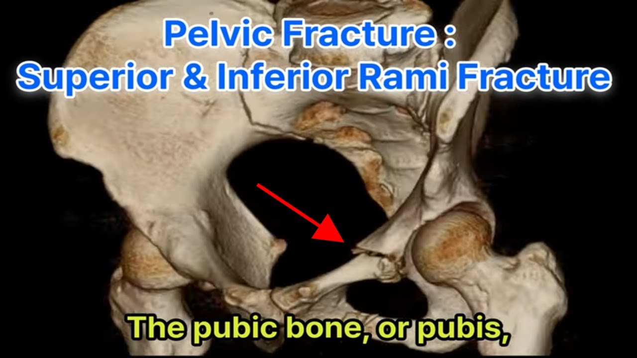 Pelvic Fracture Superior And Inferior Rami Fracture 골반 골절 치골 상하지 골절의