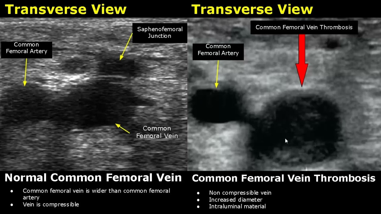 Femoral Vein Doppler Ultrasound Normal Vs Abnormal Image Appearances