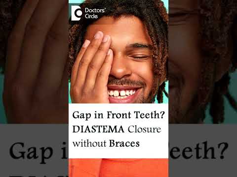 Can Braces Fix Gap Between Front Teeth