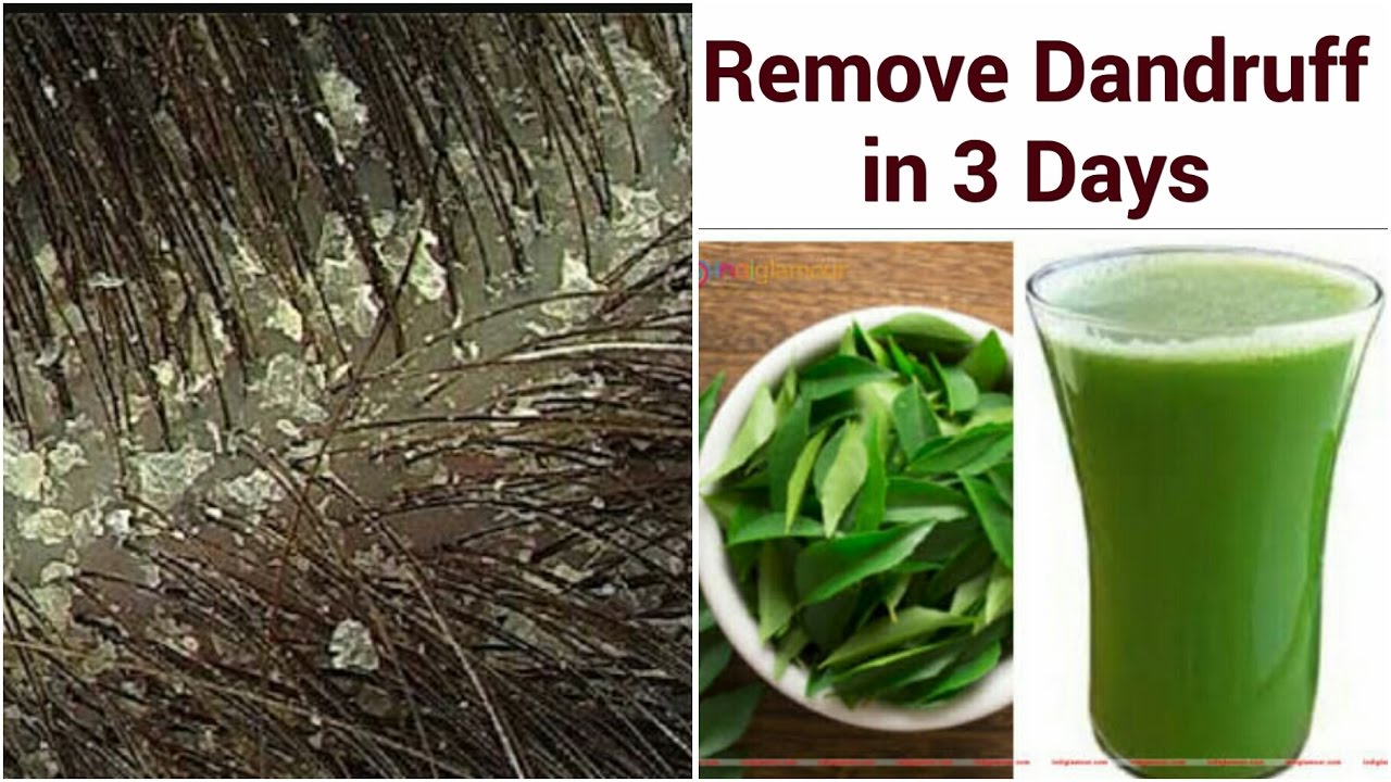 Remove Dandruff Permanently In 3 Days Naturally 2 Simple Steps Get