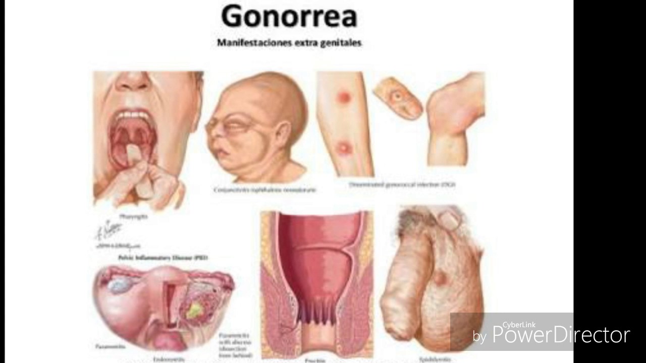 Enfermedades De Transmisión Sexual Gonorrea Youtube