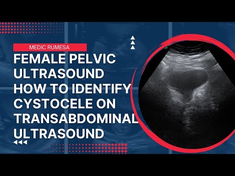 Female Pelvic Ultrasound Signs Of Bladder Prolapse Learn To Identify