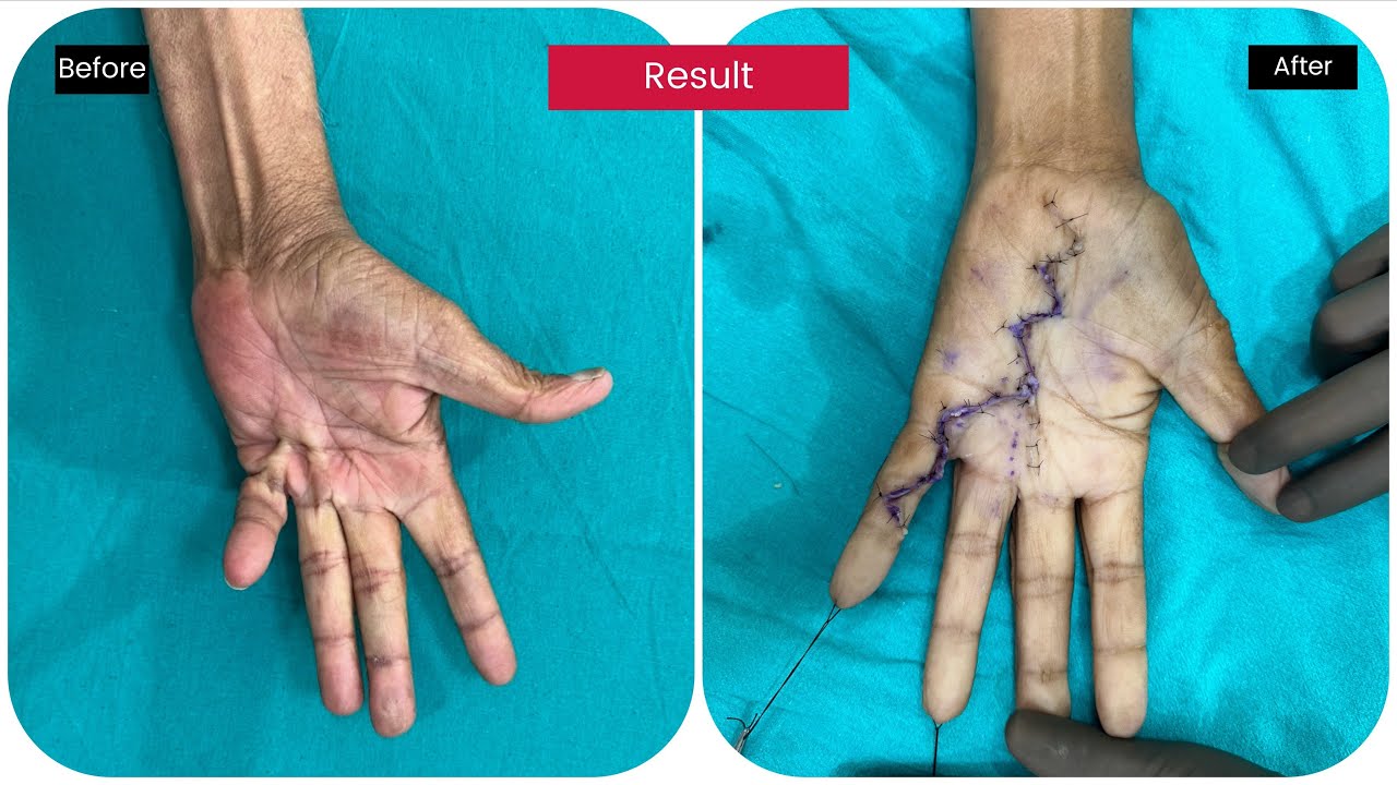 Dupuytren S Contracture Topical Treatment At Willie Liggins Blog