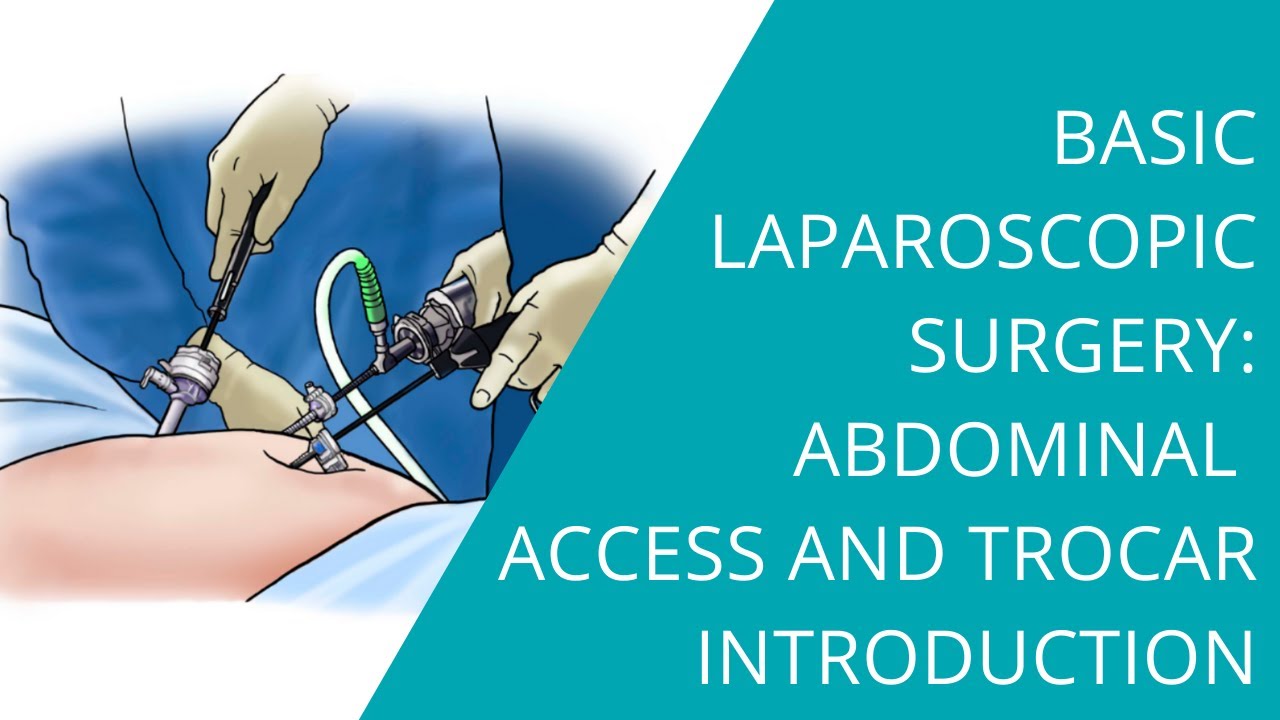 Basic Laparoscopic Surgery Abdominal Access And Trocar Introduction