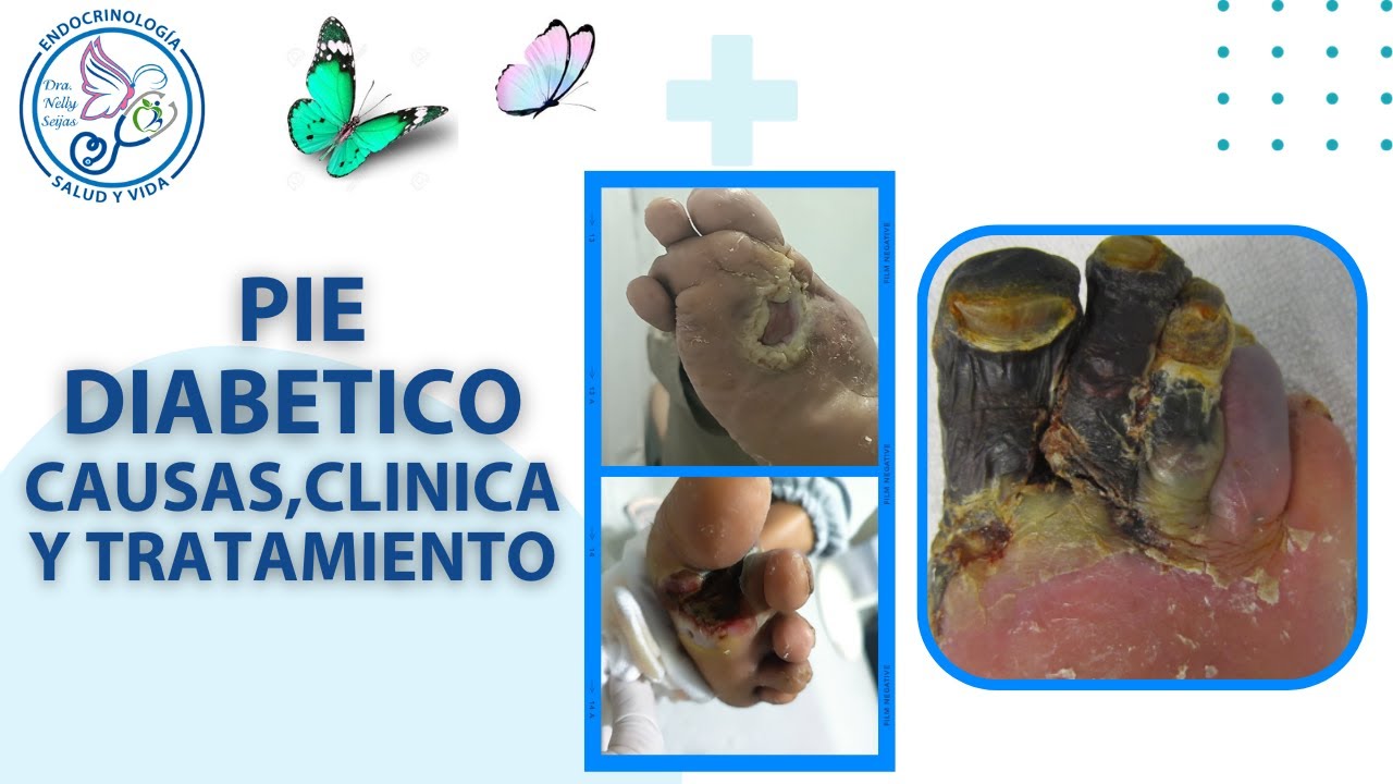 Pie Diabético Causas Clínica Y Tratamiento Youtube