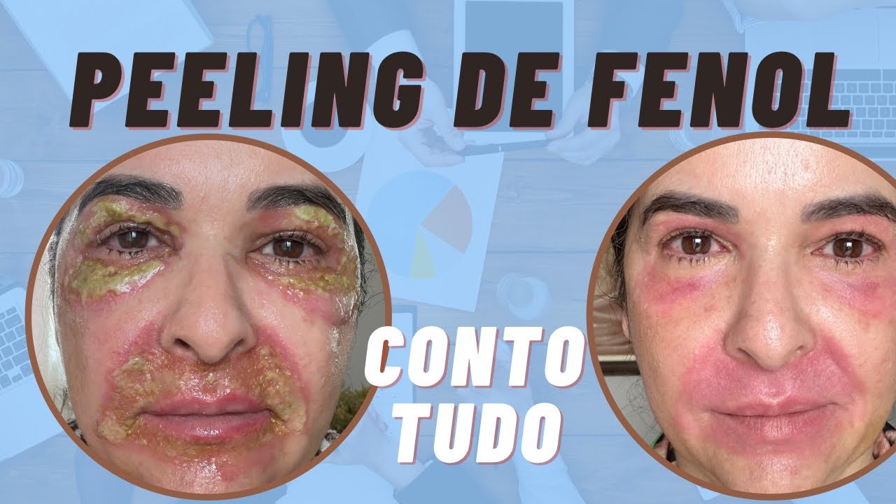Peeling De Fenol Tratamento Que Viralizou Nas Redes 51 Off
