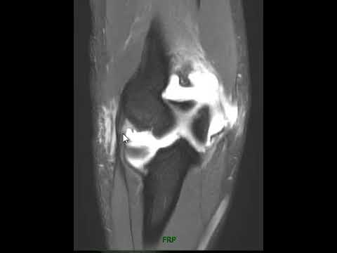 Elbow Mri Scan Also Know As Tennis Elbow Ucl Tear Proximal And
