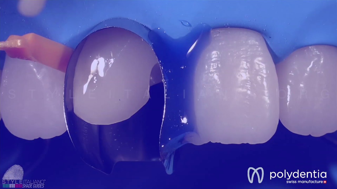 Direct Composite Resin Restoration At Federico Trout Blog