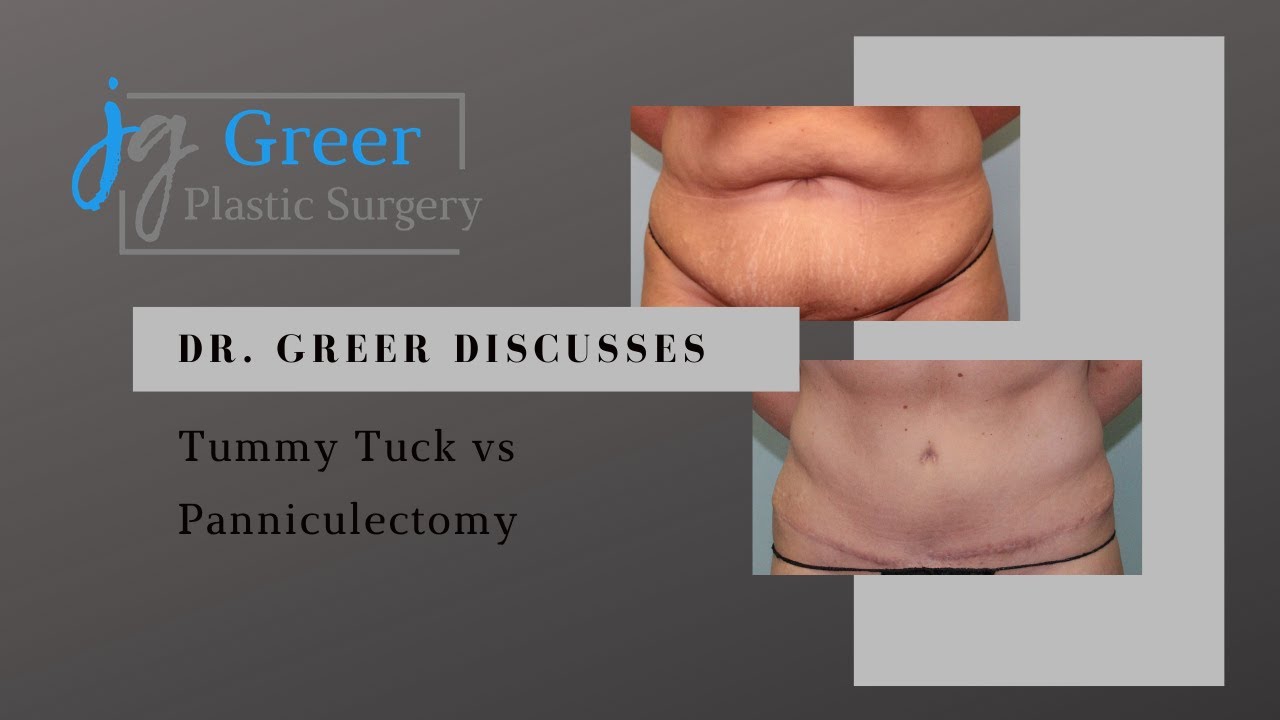 Tummy Tuck Vs Panniculectomy Greer Plastic Surgery Cleveland Oh