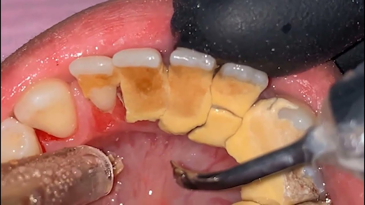 Heavy Calculus Tartar Removal Dental Calaculus Removed With