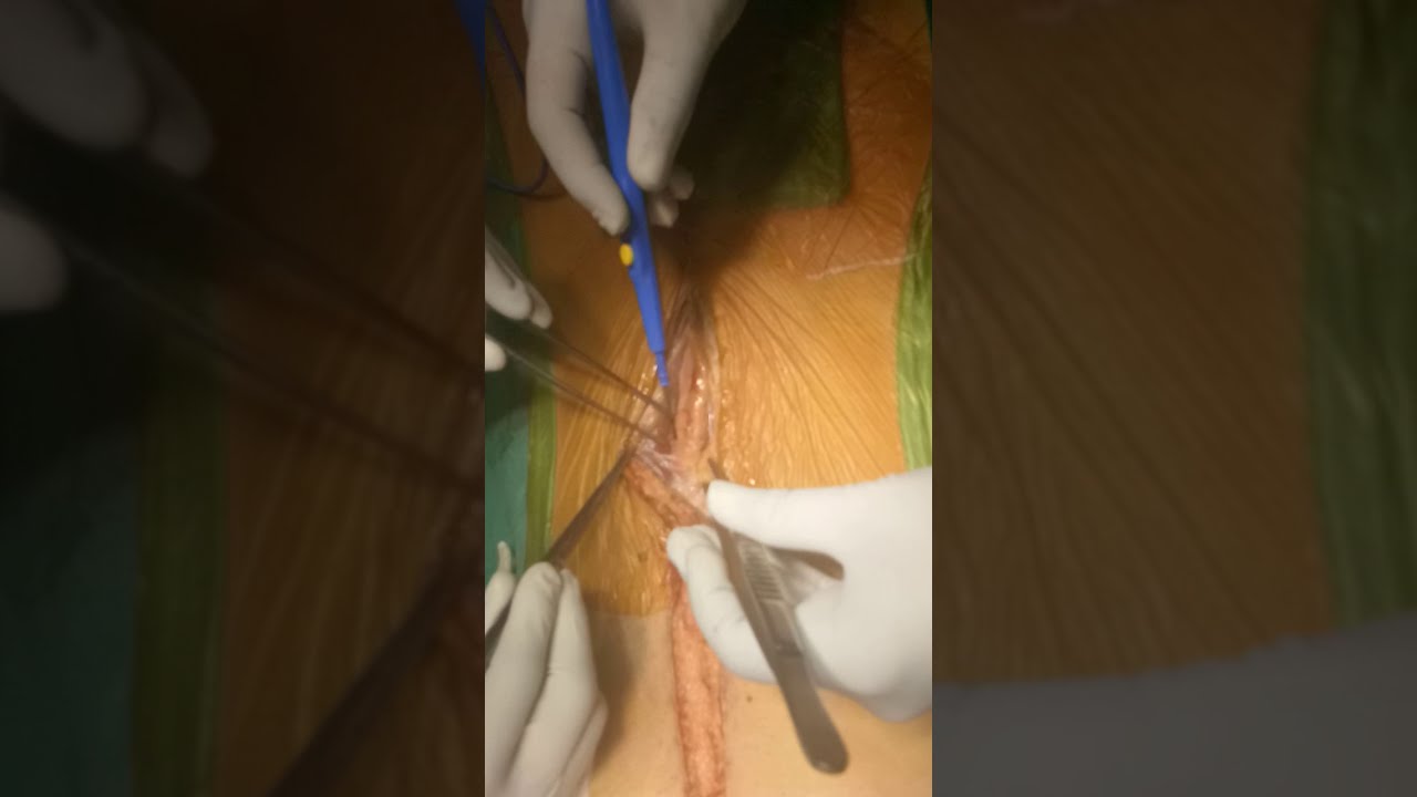 Laparotomy Youtube