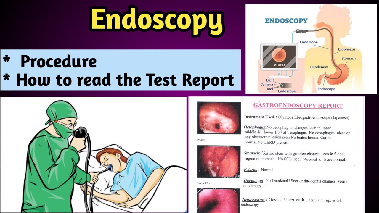 Endoscopy Detailed Video Procedure And How To Read Endoscopy Report