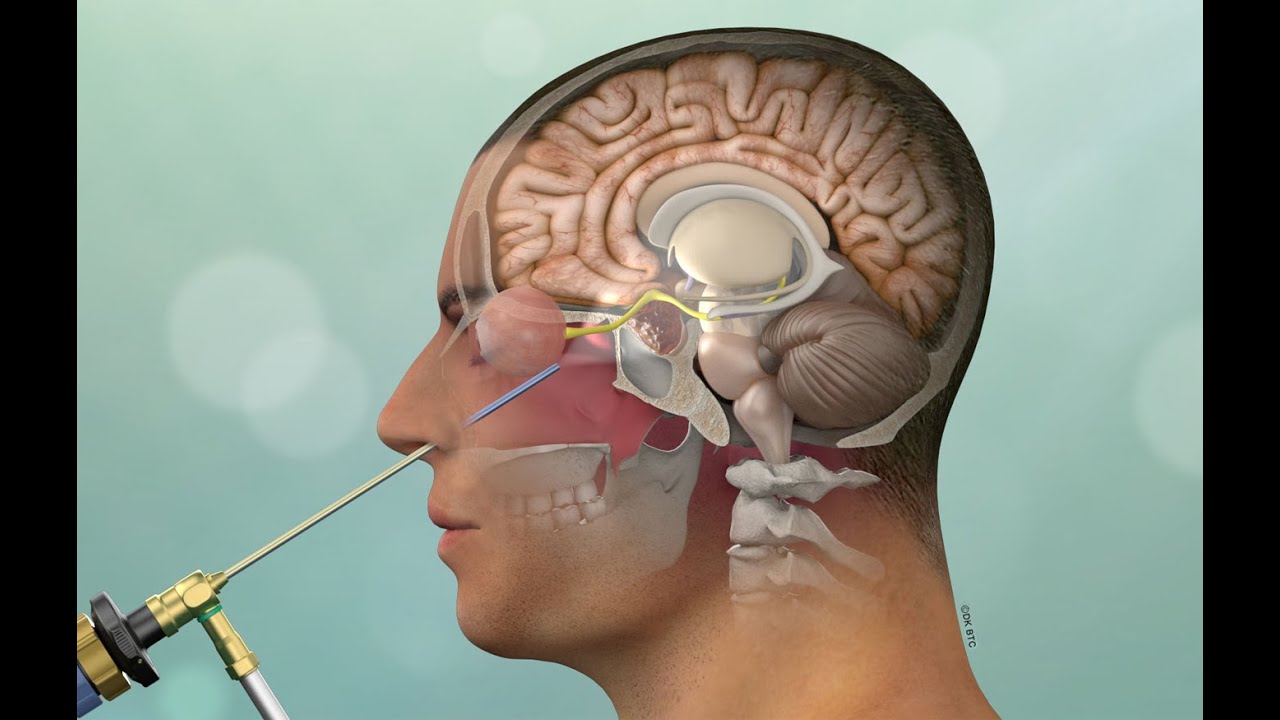 Endoscopic Transnasal Transphenoidal Excision Of Pituitary Macroadenoma