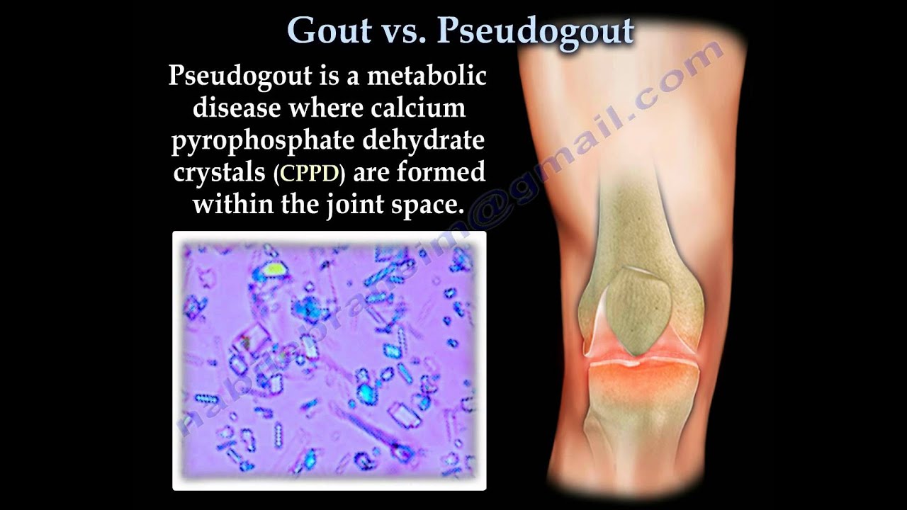 Pseudogout Knee Pseudogout Or Pseudolymphoma Calcium Pyrophosphate