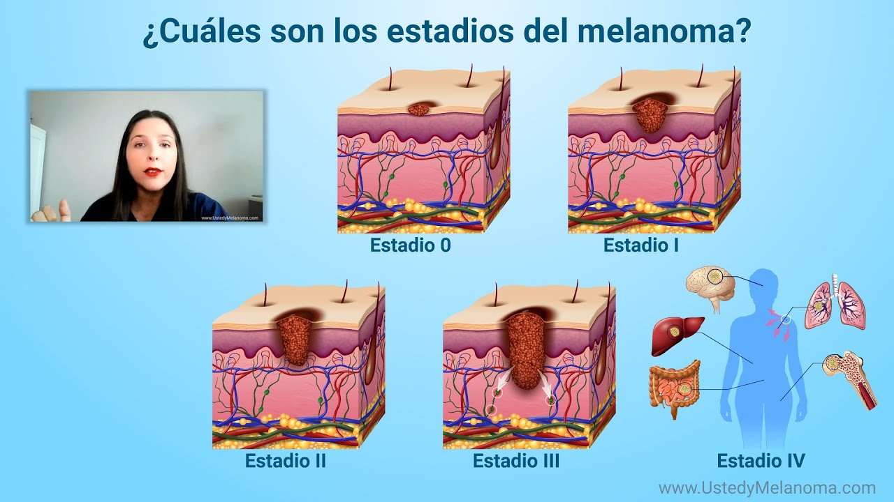 Etapas Finales Del Melanoma Rectal