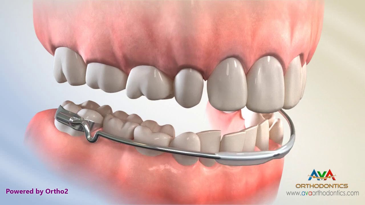 Orthodontic Space Management Lip Bumper Appliance Youtube