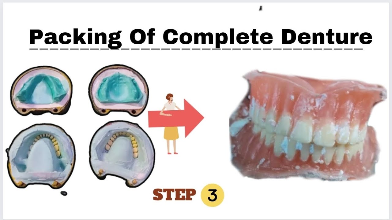 Complete Denture Processing Steps At Amber Owen Blog