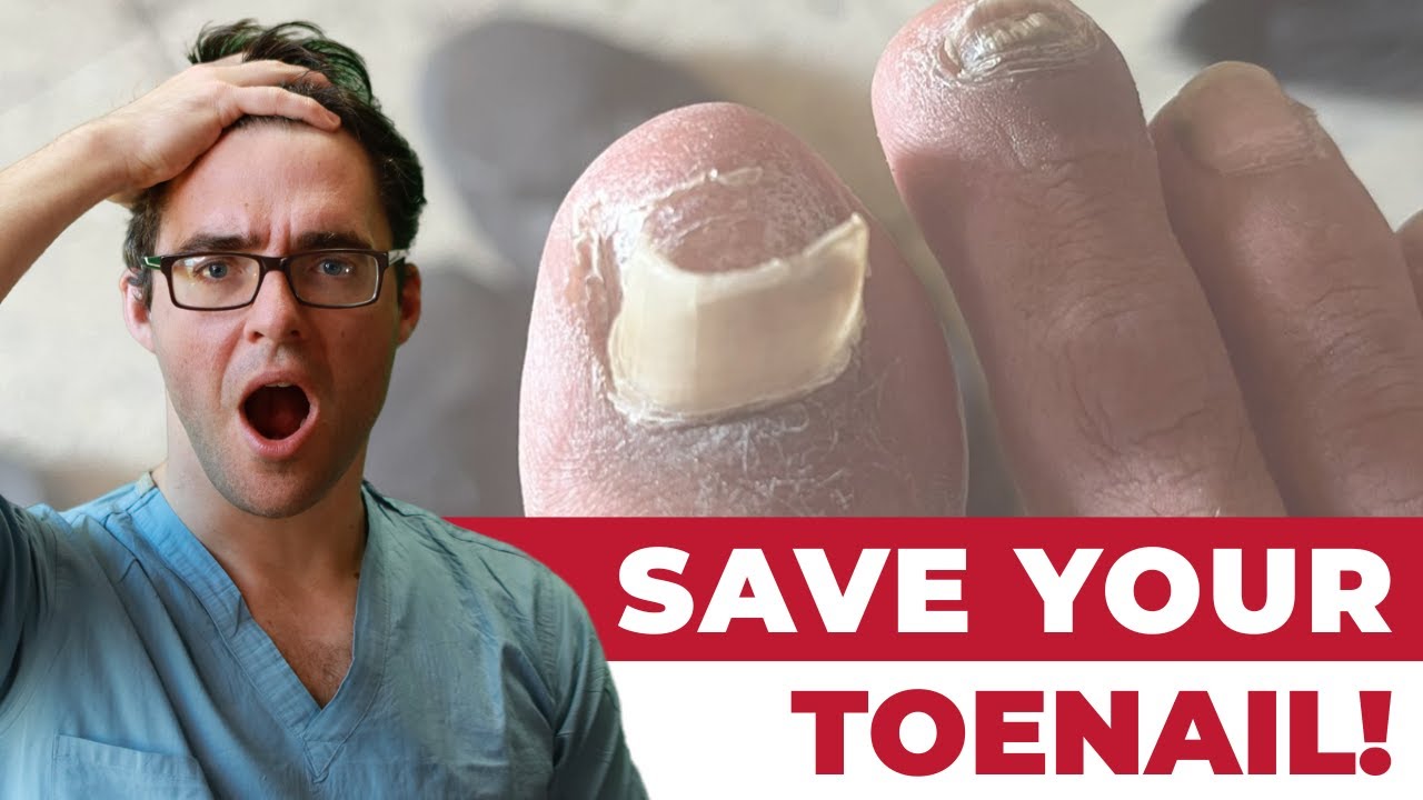 Toenail Falling Off Do This Trick Youtube