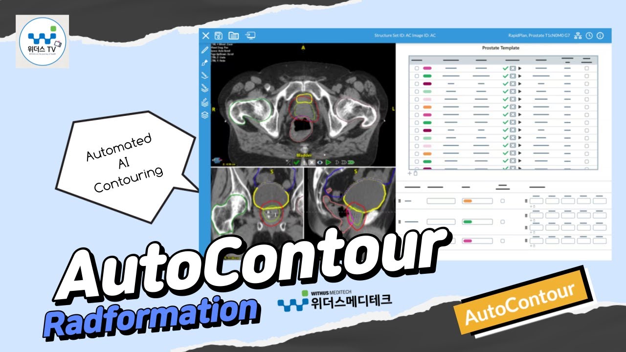 Radformationㅣintroducing Autocontour Automated Ai Contouring Software
