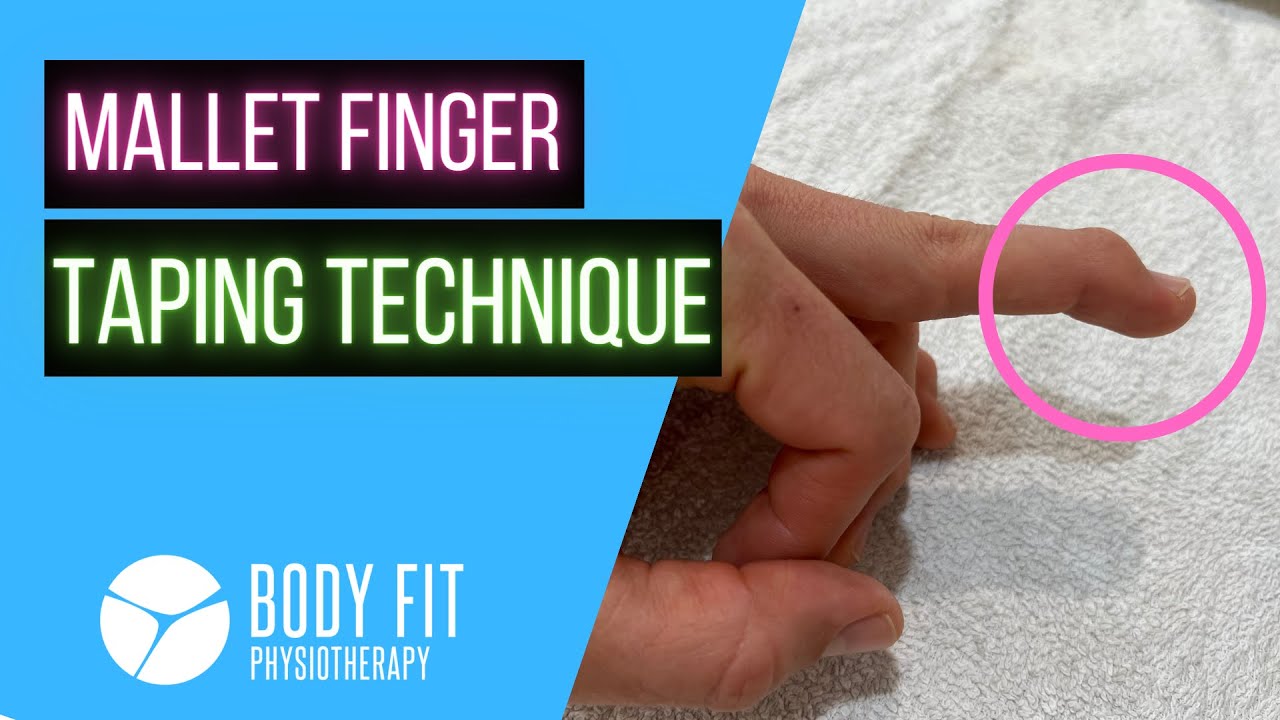 Mallet Finger Exercises Nhs At Irene Defilippo Blog