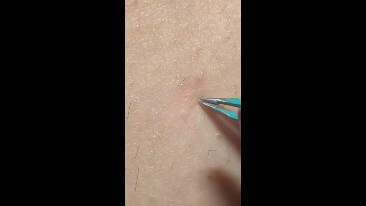 Ingrown Hair Removal Youtube