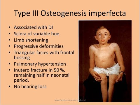 Osteogenesis Imperfecta Tipo Iii Terapia Ocupacional Youtube