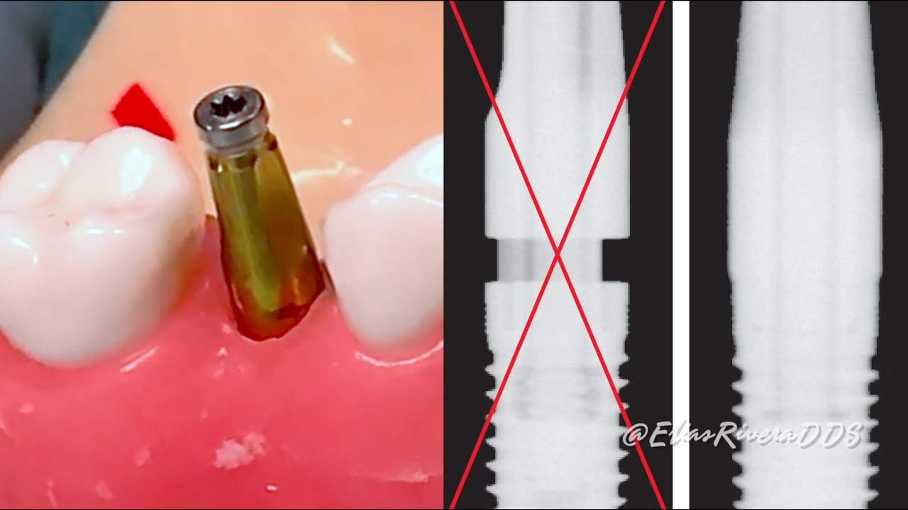 Implant Closed Tray Impression Technique At Priscilla Scott Blog