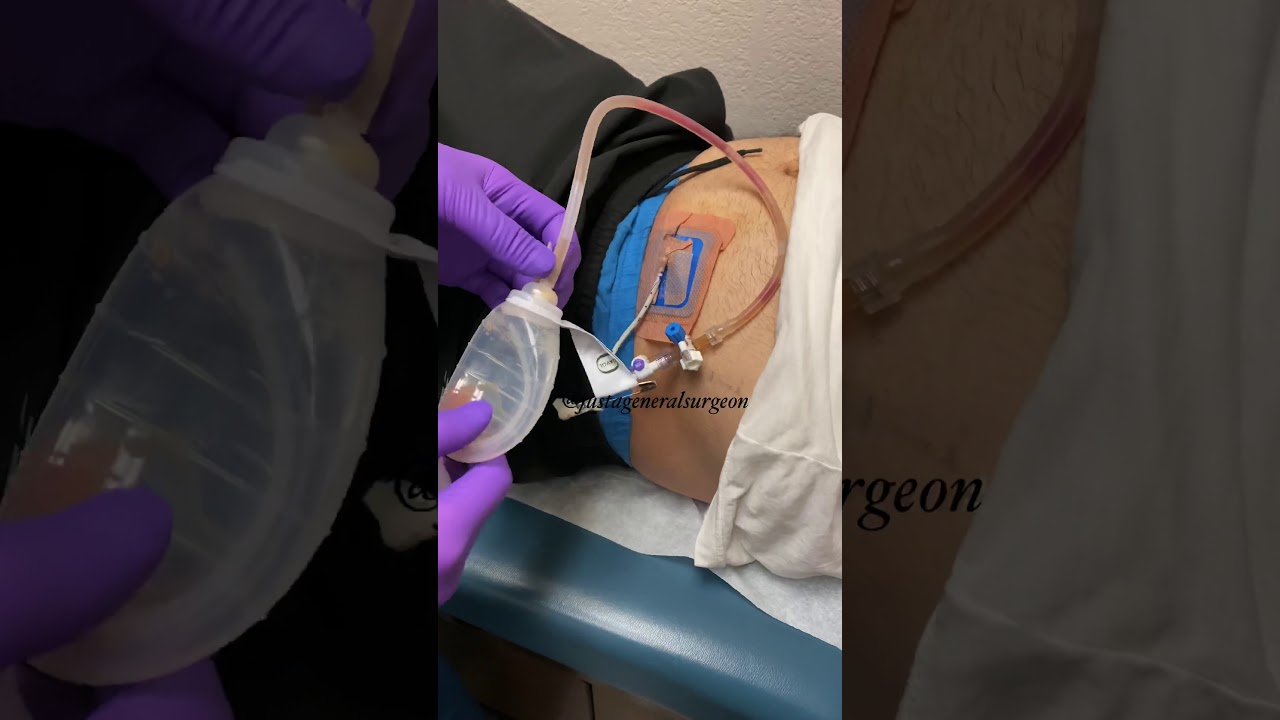 Pigtail Drain Removal Nursing Guidelines Pleural And Mediastinal