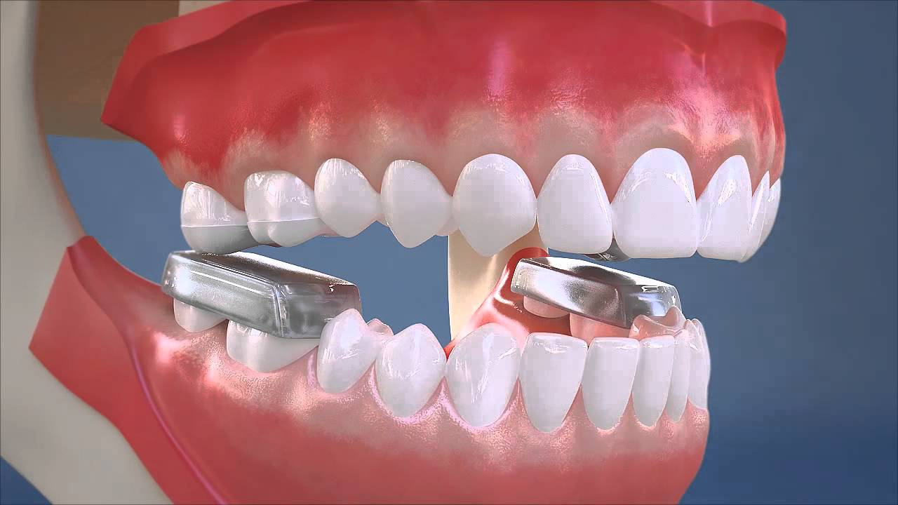 Anterior Openbite Bite Block Hd Youtube