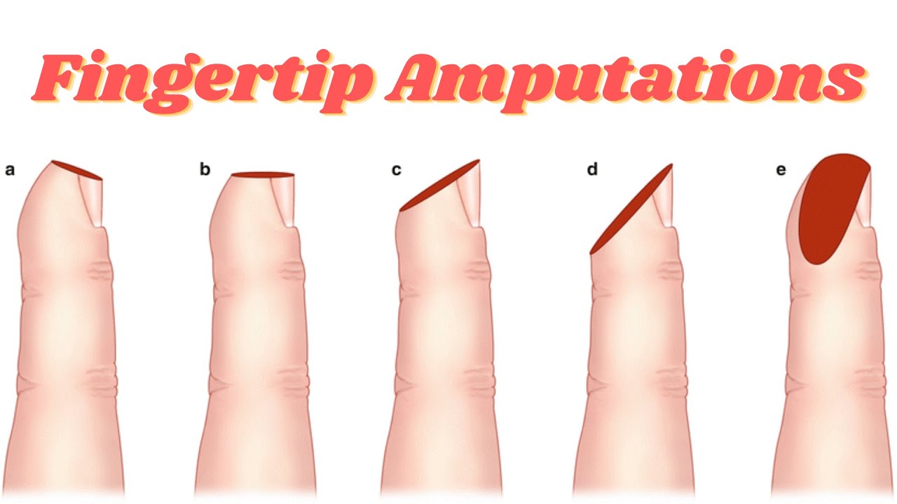 Burn Fingertip Gone White At Carly Decosta Blog