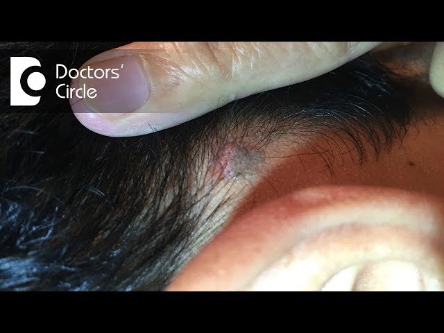 Why Do I Have A Hard Lump Behind My Ear Infoupdate Org