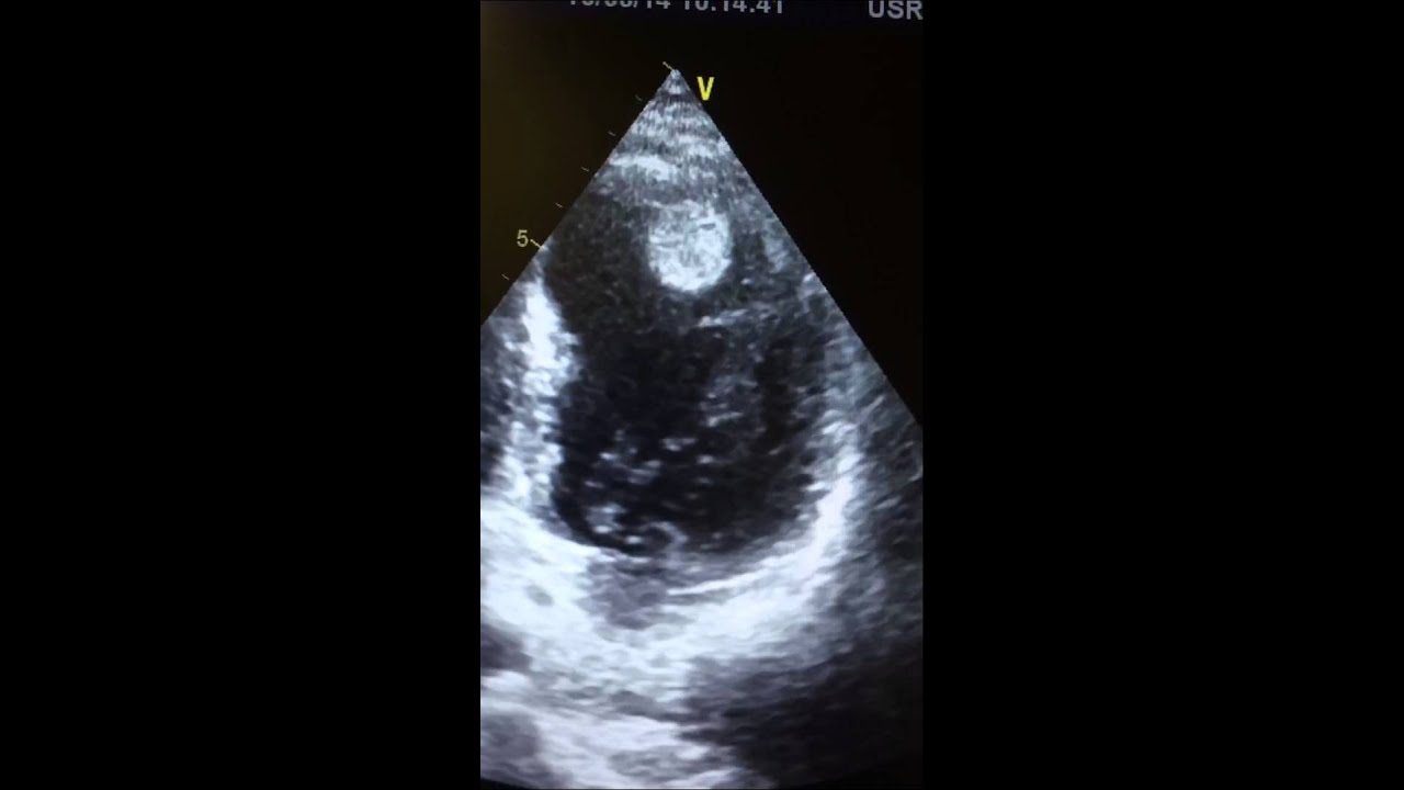 Lv Thrombus Uptodate Semashow