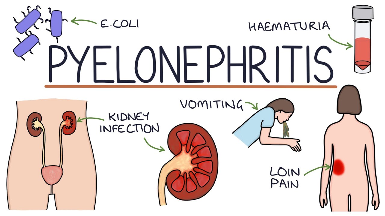 Understanding Pyelonephritis Kidney Infections Youtube