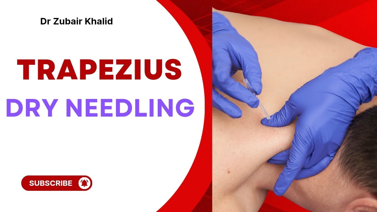 Effective Dry Needling Electrotherapy For Upper Trapezius Trigger