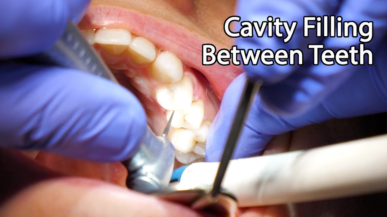 Dentist Filling A Cavity Between Teeth Youtube