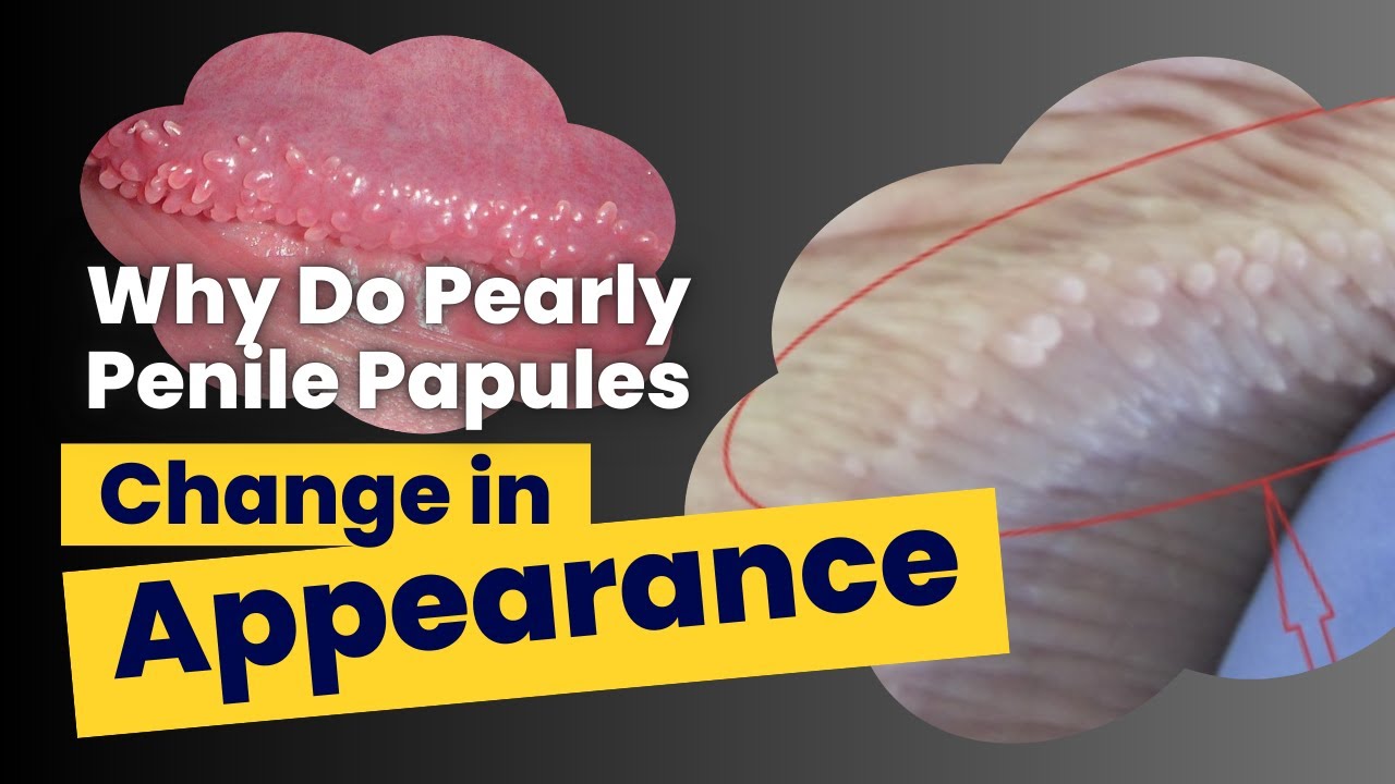 What Causes The Appearance Of Pearly Penile Papules To Change Youtube