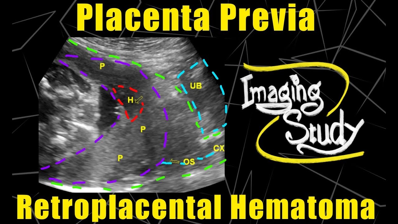 Complete Placenta Previa With Retroplacental Hematoma Ultrasound