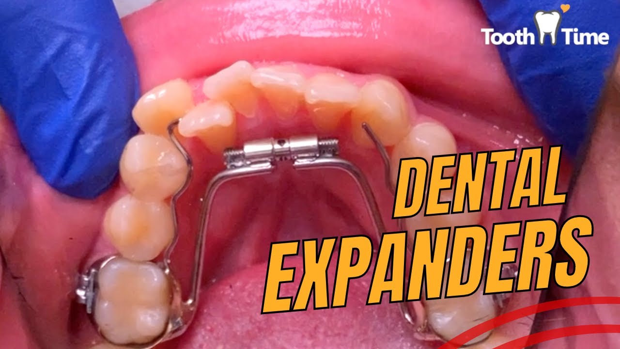 How To Turn A Dental Expander Full Video Braces On Toothtime New