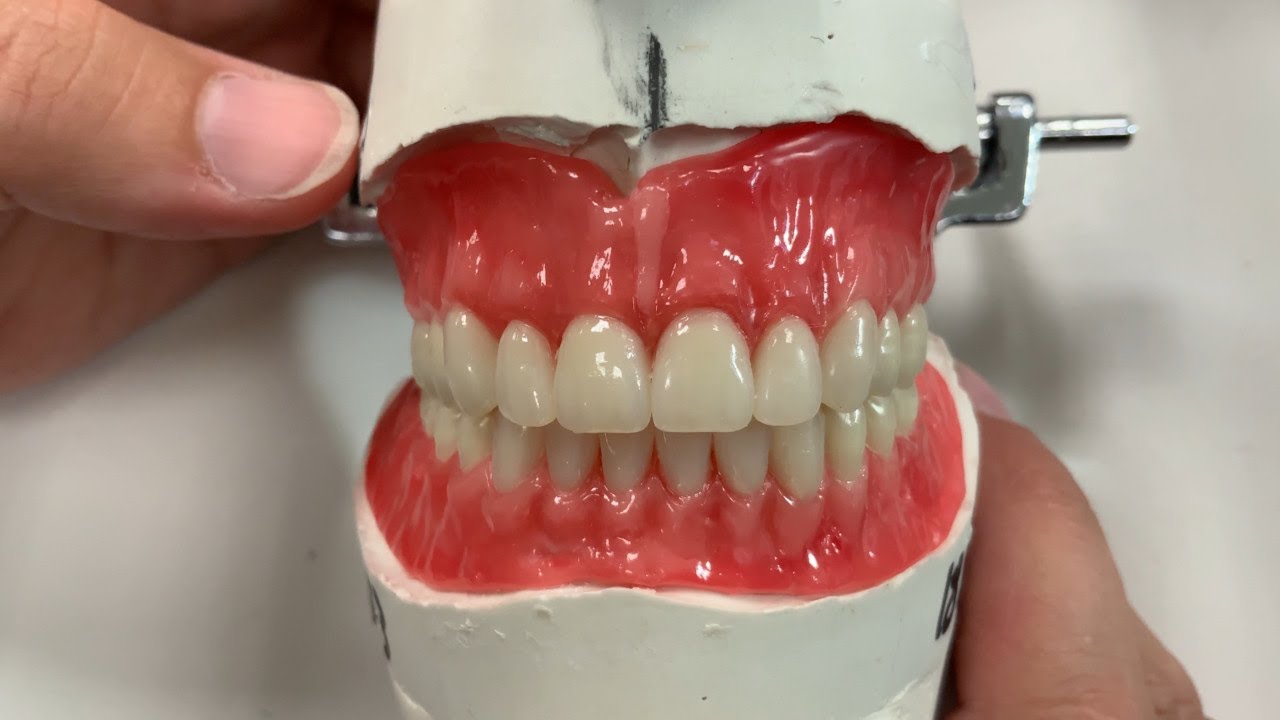 Removable Partial Denture Wax Try In At Ellie Corrigan Blog