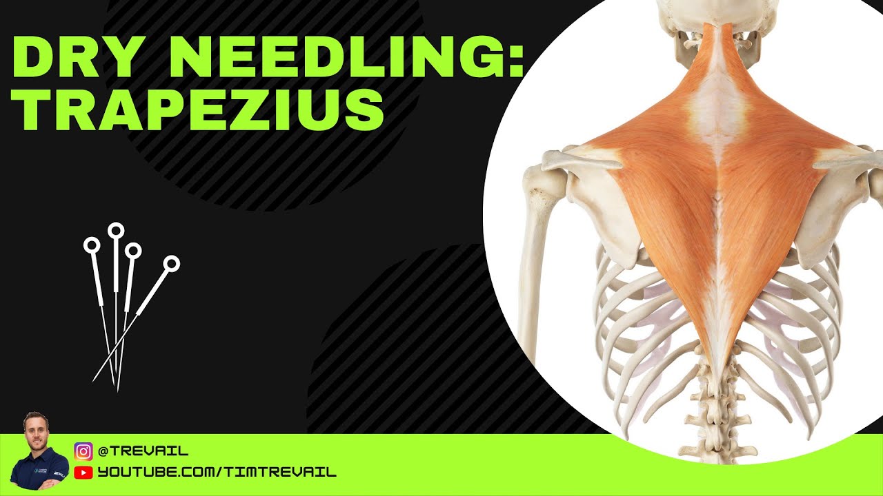 Dry Needling Trapezius Youtube