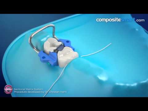 Smartview Sectional Matrix Rubber Dam Clamp Procedure Youtube